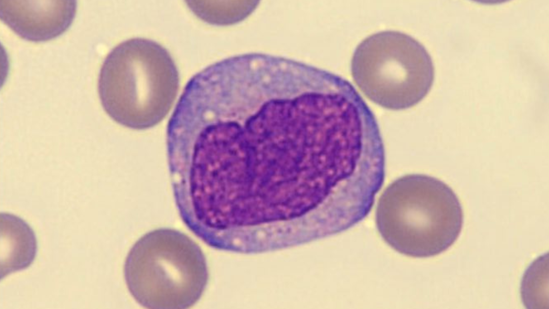 Curso Avançado de Morfologia em Leucemias e Linfomas – Curso de ...