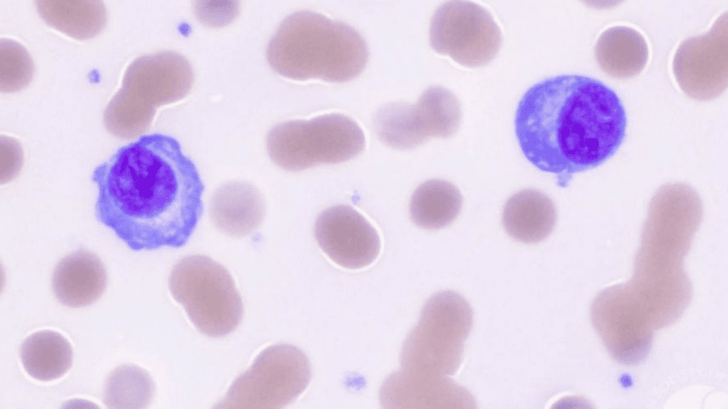 Curso Avançado de Morfologia em Leucemias e Linfomas – Curso de ...