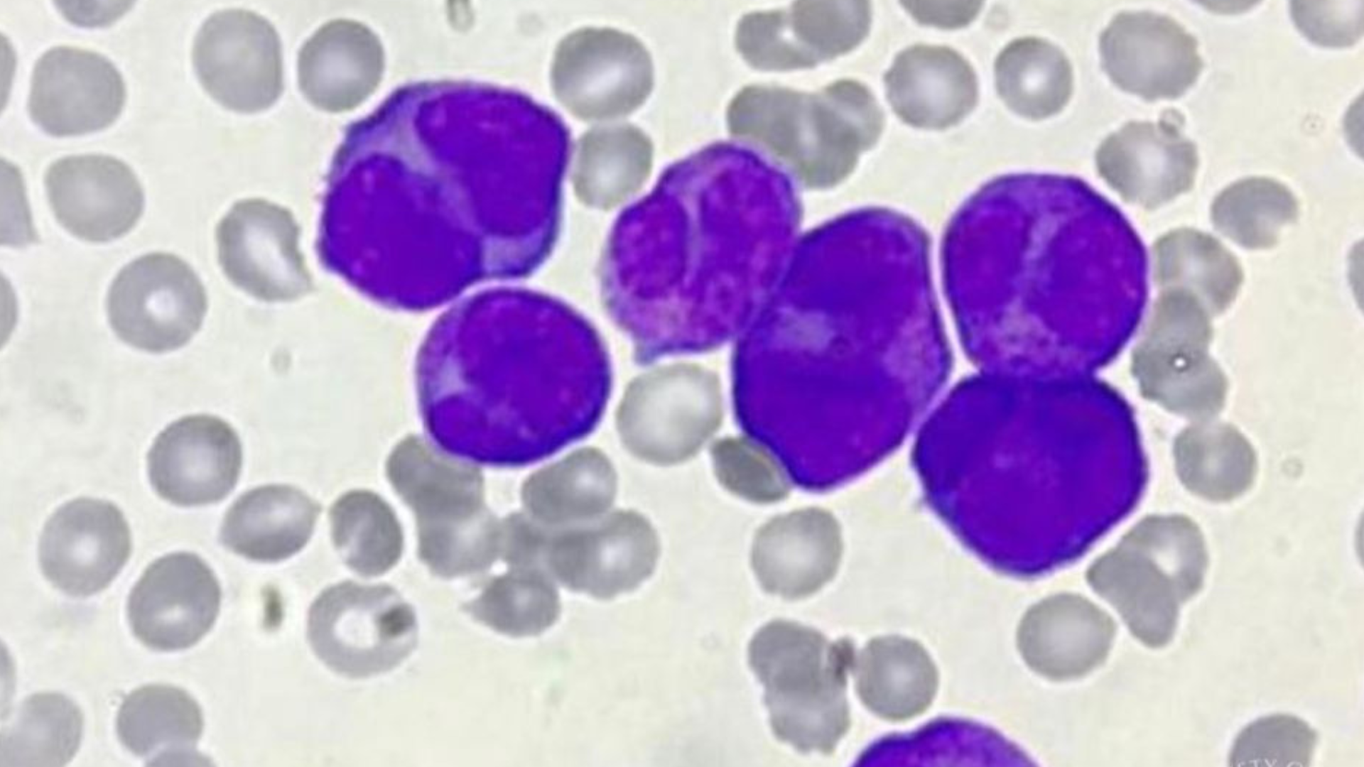 Curso Avançado de Morfologia em Leucemias e Linfomas – Curso de ...